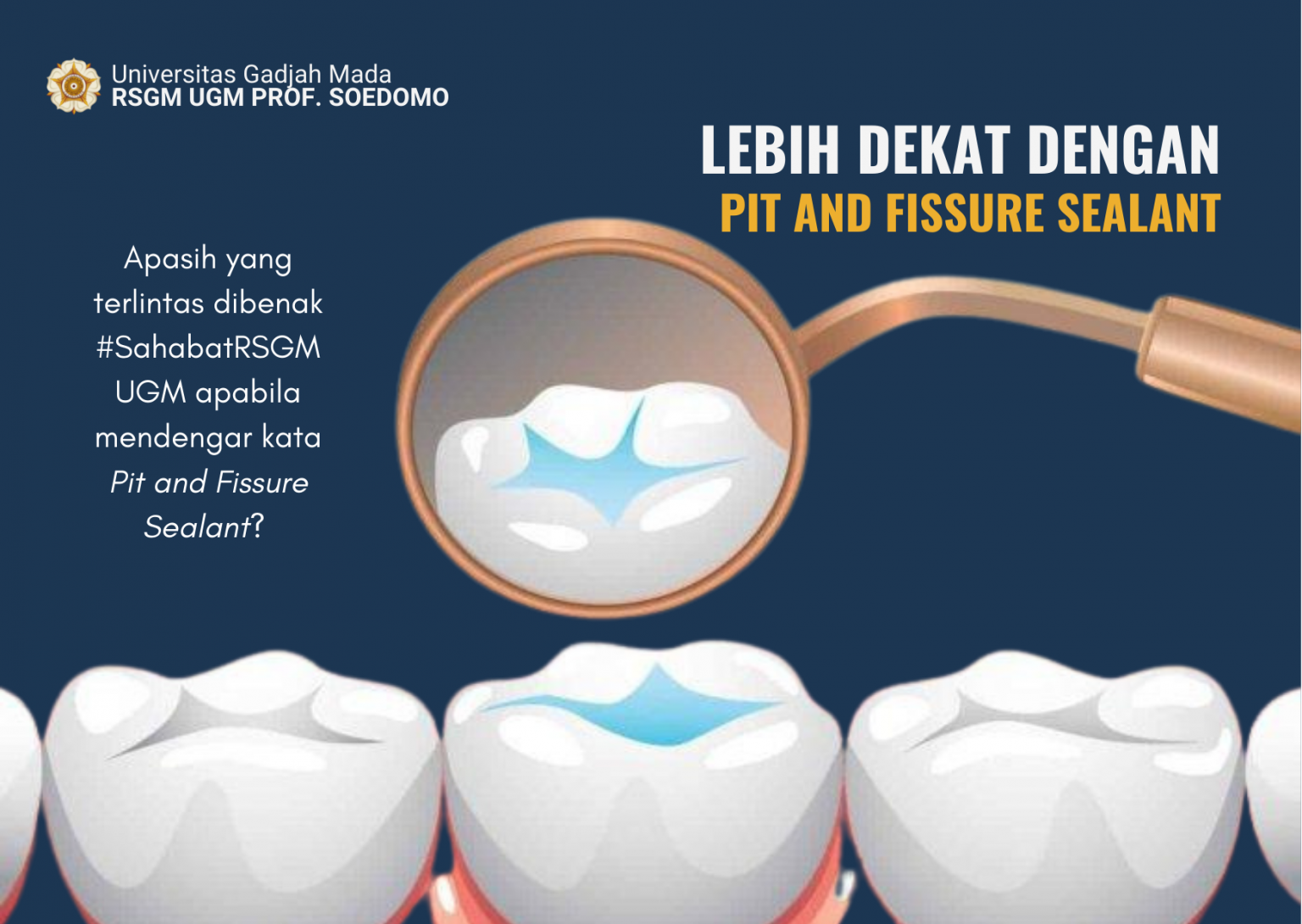 LEBIH DEKAT DENGAN PIT & FISSURE SEALANT. – RSGM UGM Prof. Soedomo